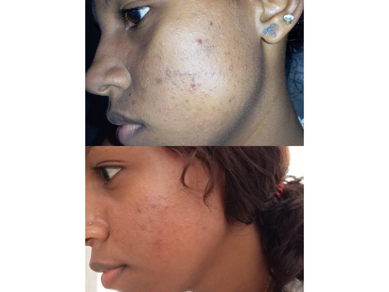 Smooth Skin: Elimina el Acné – LaMiaSkin